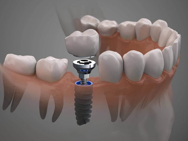 Single Tooth Implants Houston TX - Dentiq Dentistry