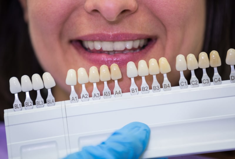 5 Things You Need To Know Before Getting Porcelain Veneers