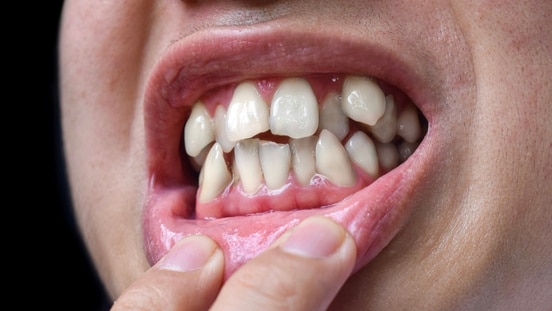 Can a Cosmetic Dentist Fix Crooked Teeth without Braces?